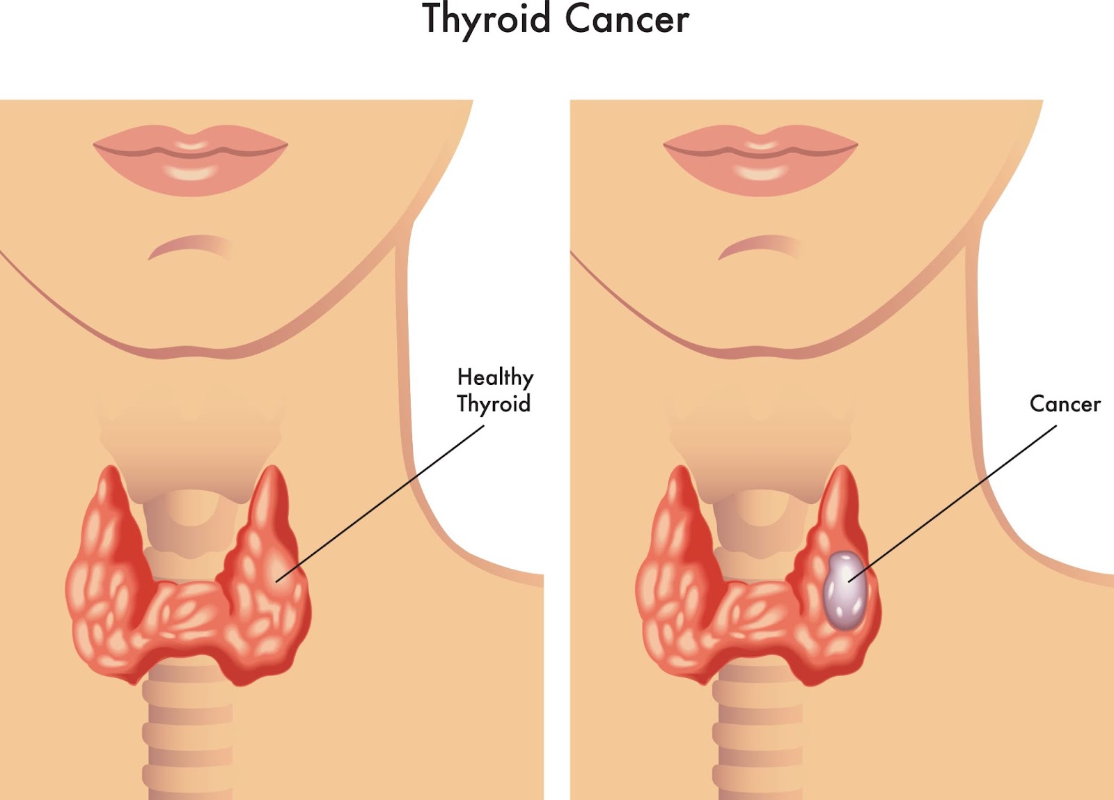 Thyroid Surgery In Malaysia Expert Thyroidectomy And Nodule Removal 4413